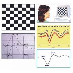 POTENCIAL OCULAR EVOCADO | Fundus S.A. Laboratorio de diagnóstico por ...